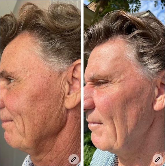 MIRIA Laser Resurfacing - VivaSkin Dermatology